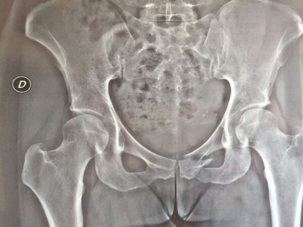 Frattura ischio pubica: guida completa - Ortopedico Italia