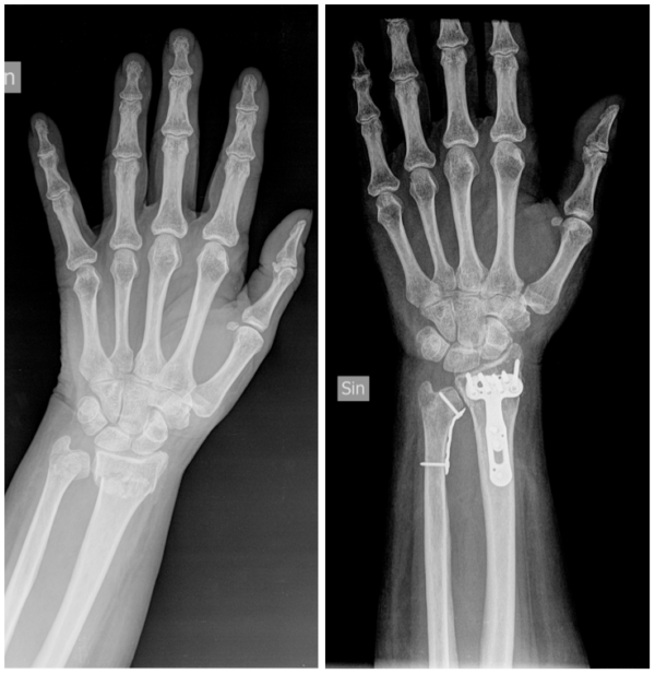 Frattura epifisi distale del Radio: una guida completa - Trova subito ...