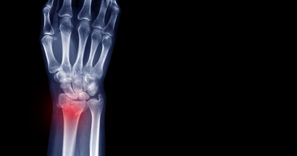 Frattura di colles: cos'è, diagnosi e cura - Ortopedico Italia