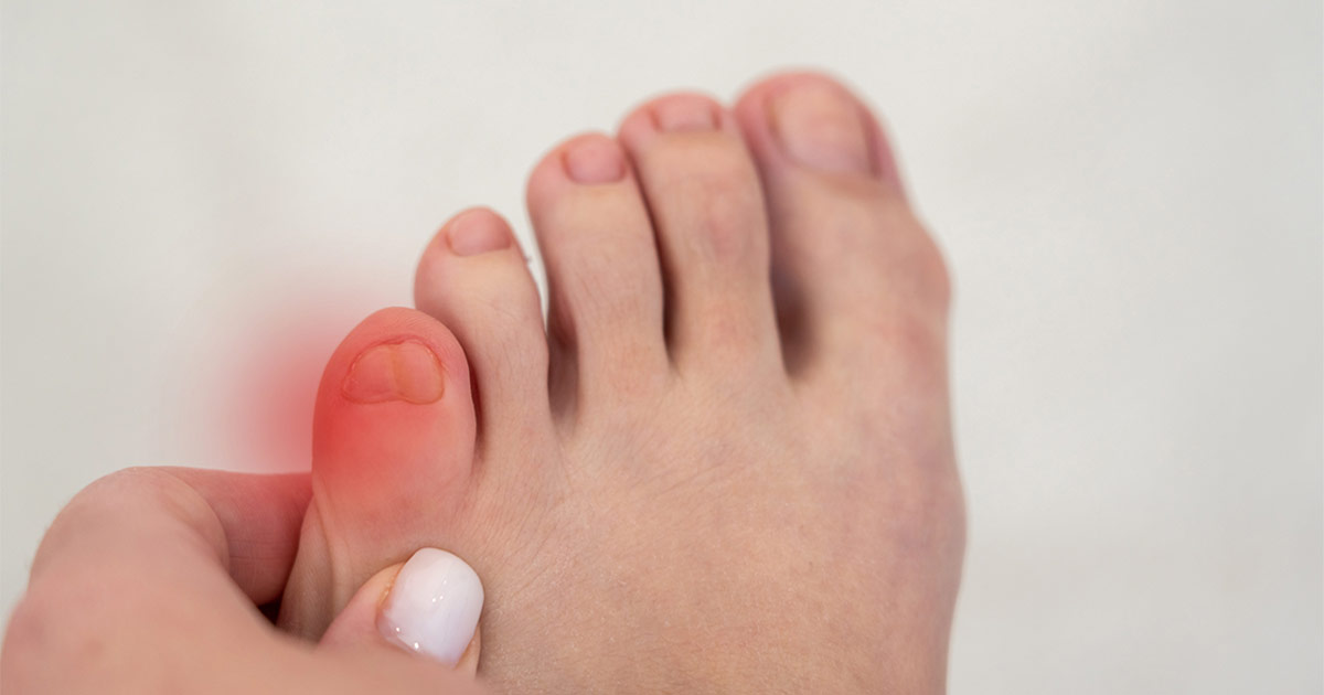 Frattura del Quinto dito del piede o mignolo: Consigli, terapia e ...